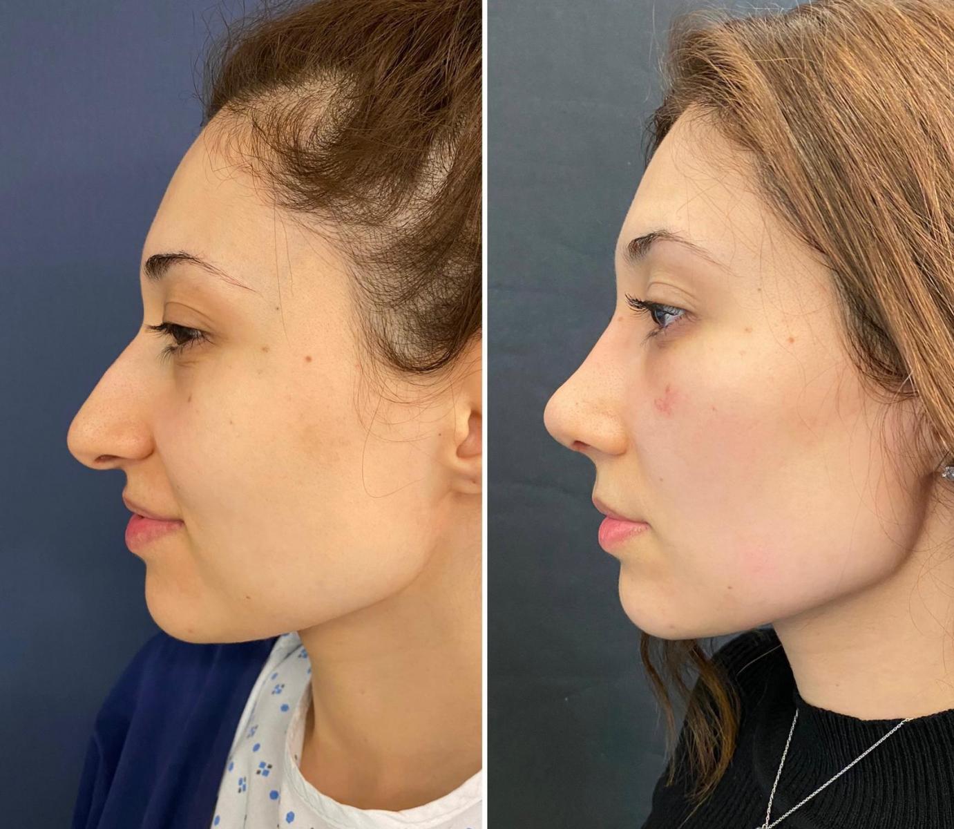 NANO FAT GRAFTING - Dr. Lalit Rajpal